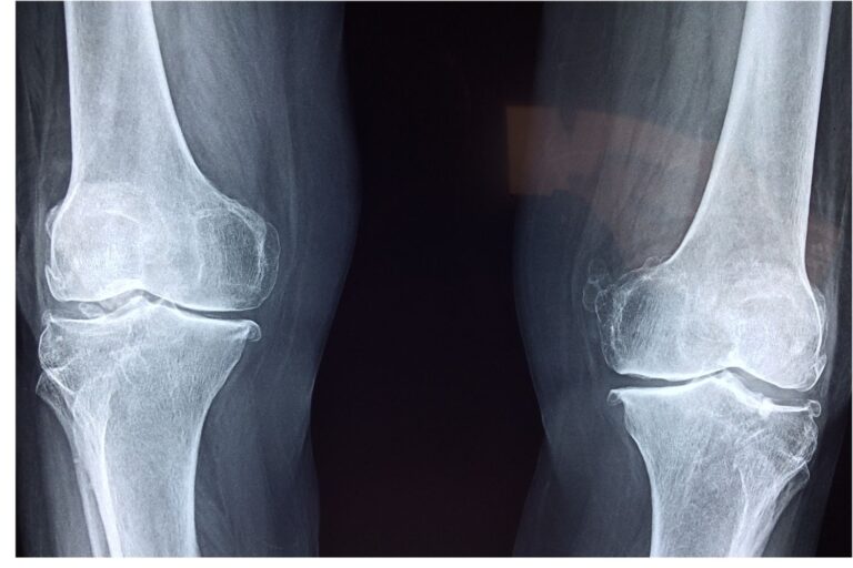 Ziarninowanie rany – Sklep Medyczny Madens